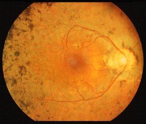 La Retinite Pigmentosa (RP)